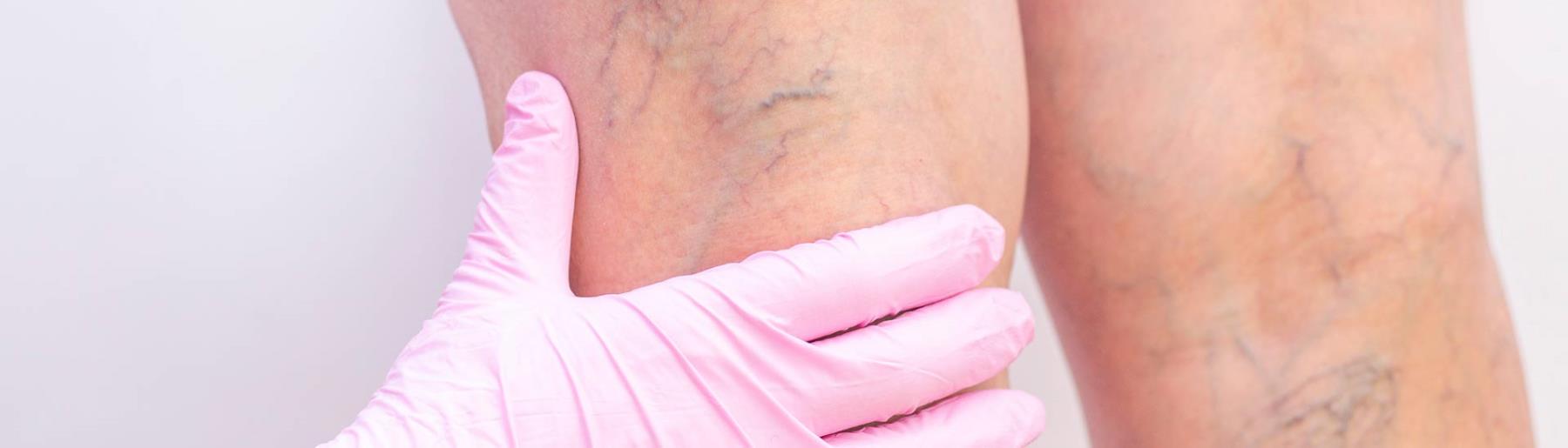 Spider Veins Varicose Veins Sunshine Vascular